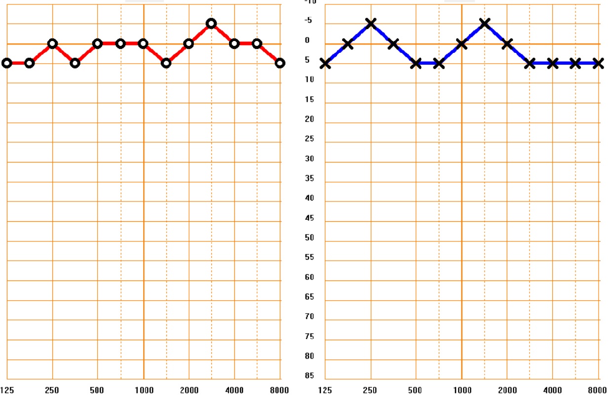 Ecg - Audiometry